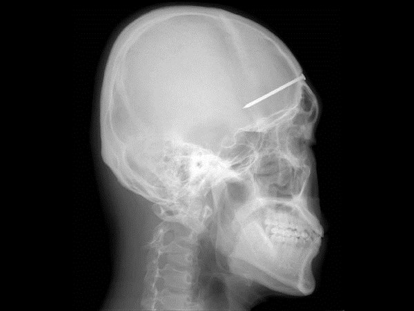 worst x rays in the world - Telugu Gizbot