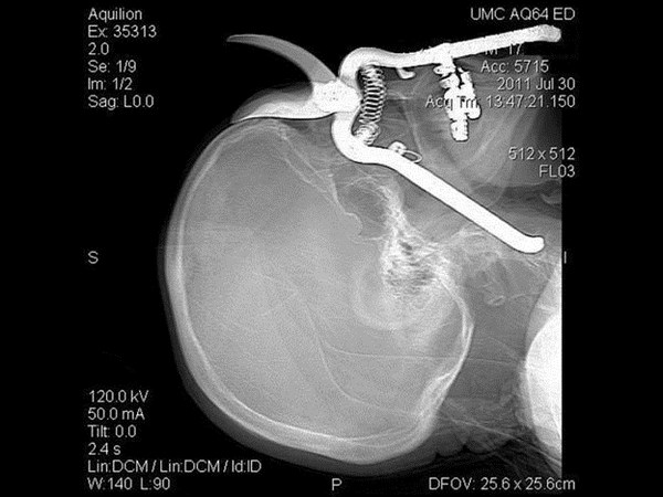 worst x rays in the world - Telugu Gizbot